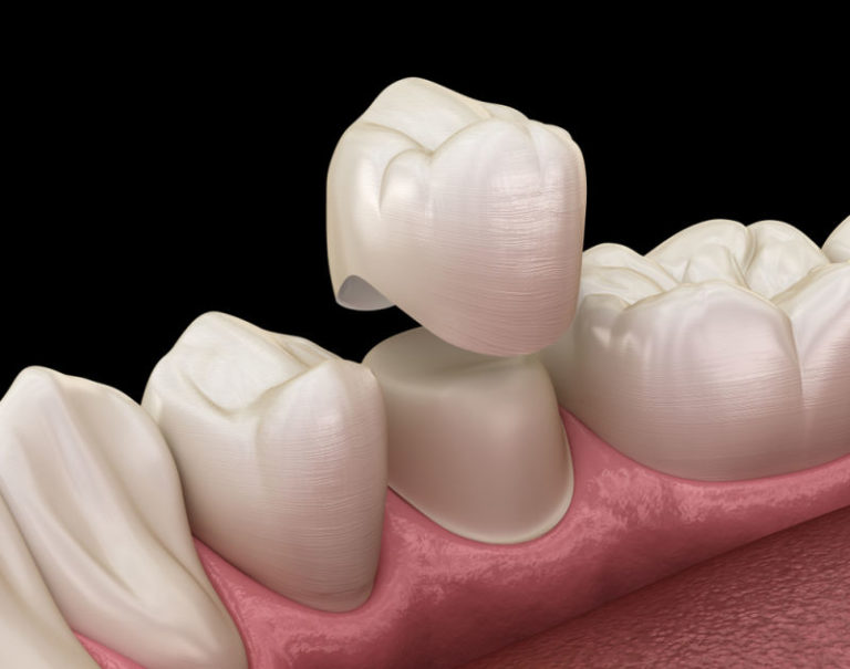 what-is-a-dental-crown-westborough-dentist